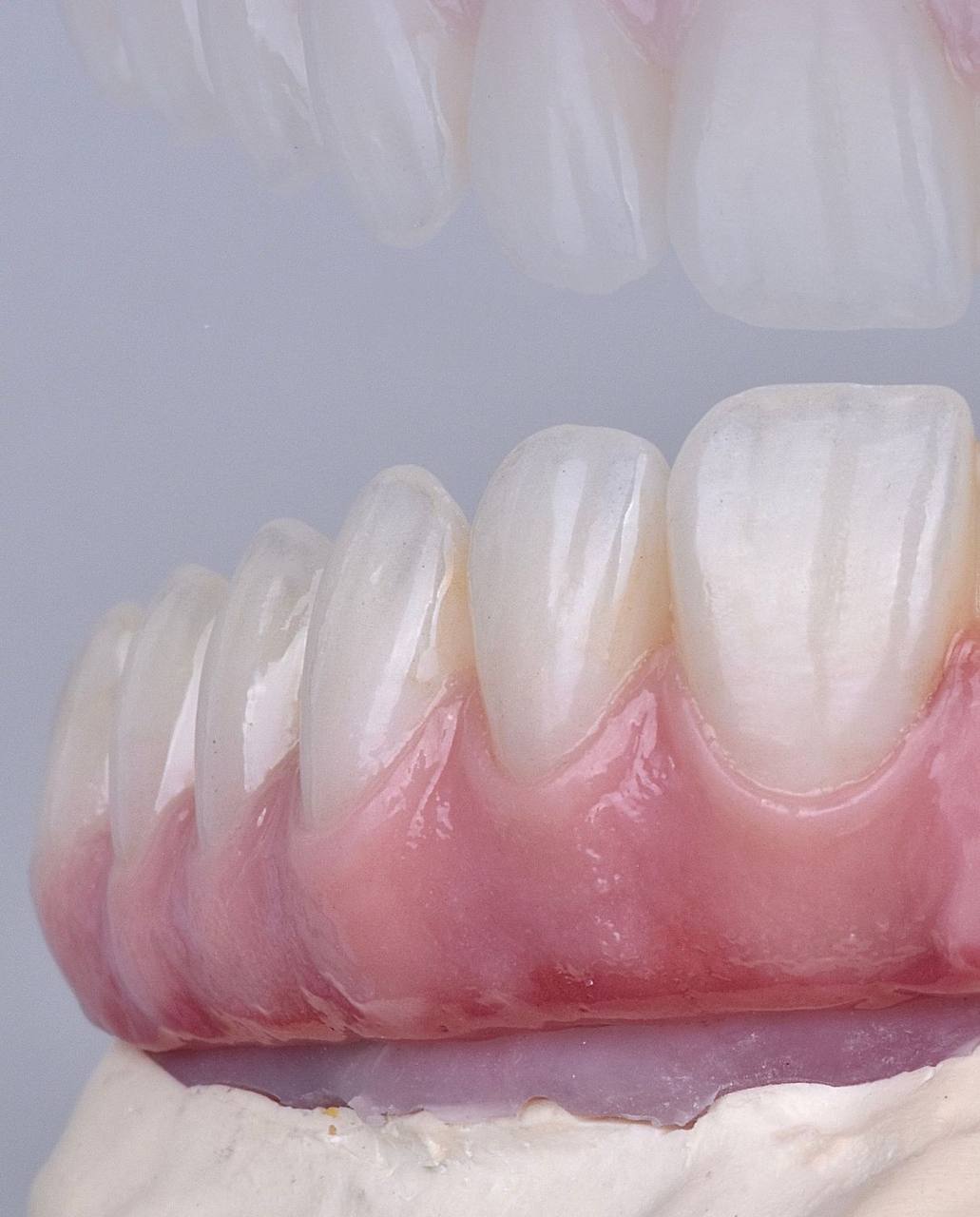 Prótese Protocolo – Ateliê Odontologia